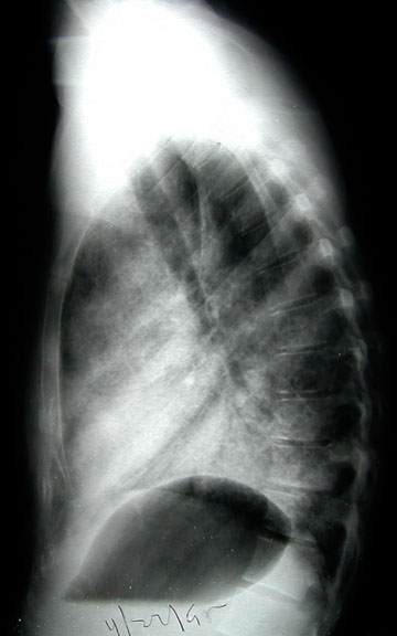 Dark lung fields