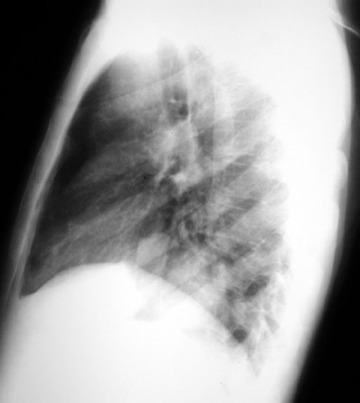 Dark lung fields