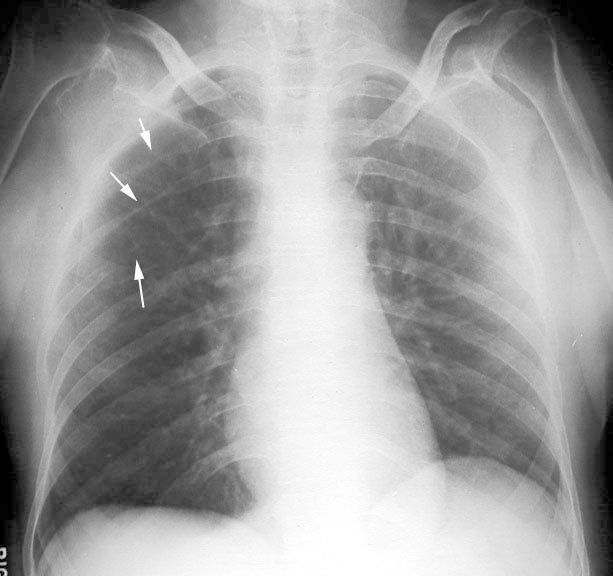 Erosion of Posterior Ribs