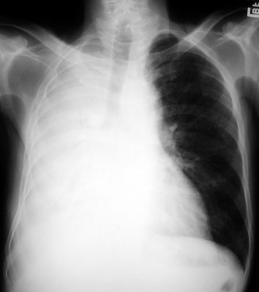 The right lung is atelectatic. You can see air bronchogram, which ...