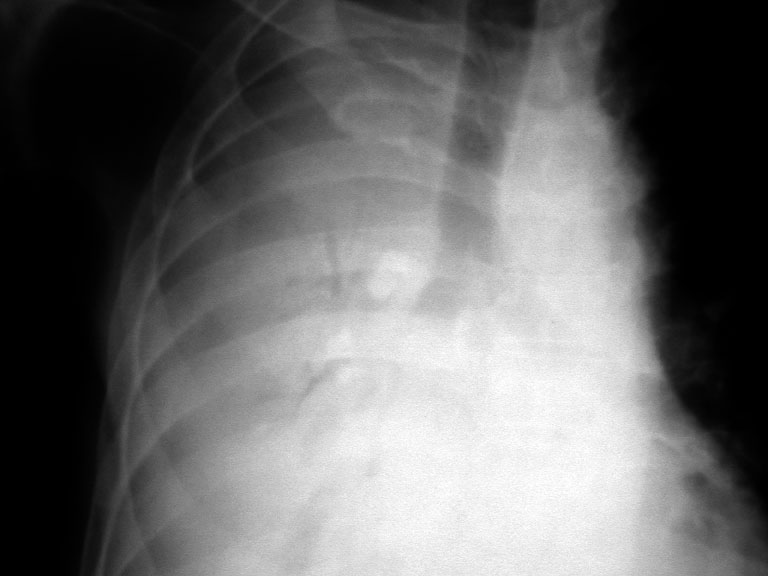 Open Bronchus Sign / Alveolar Atelectasis