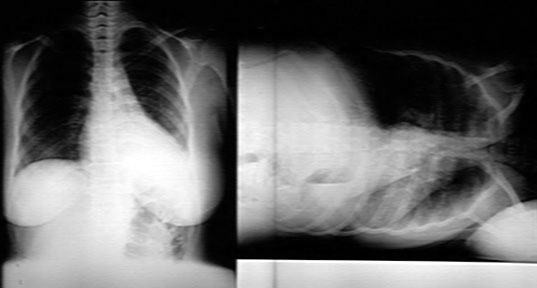 Left lower lobe atelectasis