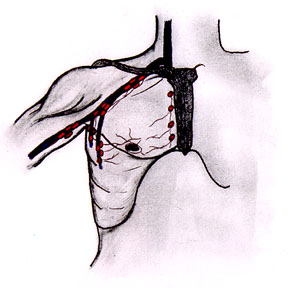 Anatomy of axilla lymph node grouping in axilla