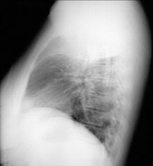 Right upper lobe consolidation