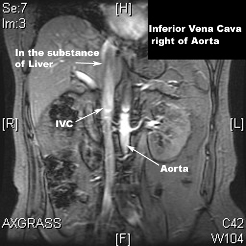 Inferior Vena Cava