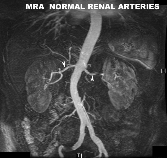 PA view Reconstructed image MRA