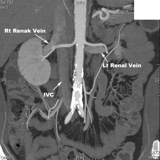 PA view Reconstructed image Renal veins entering IVC