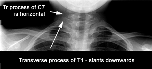 Identify the 1st thoracic vertebra and 1st rib. Click the image for ...