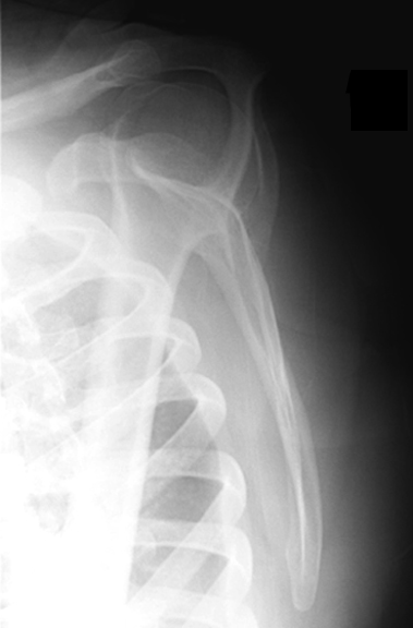 Identify parts of the scapula. Click the image for labeling.