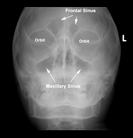 identify the frontal and maxillary sinus click the image for labeling
