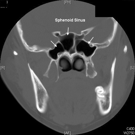 identify the sphenoid sinus click the image for labeling