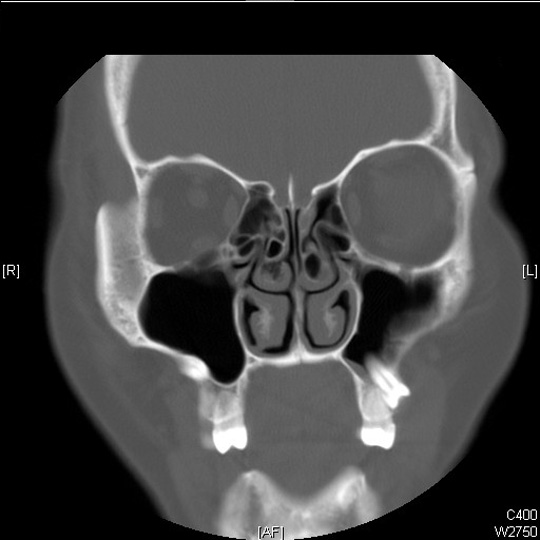 Appreciate the relationship of the maxillary sinus to the orbit and ...