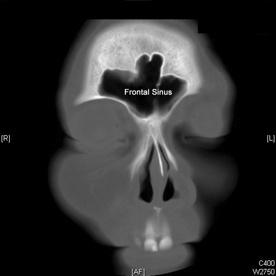 identify the frontal sinus click the image for labeling