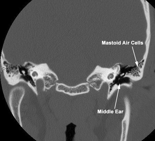 appreciate the relationship of the middle ear to mastoid air cells ...