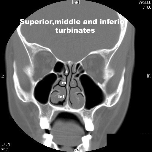 identify nasal turbinates