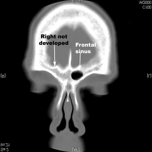 identify frontal sinus