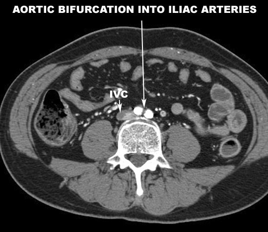 Common Iliac Artery