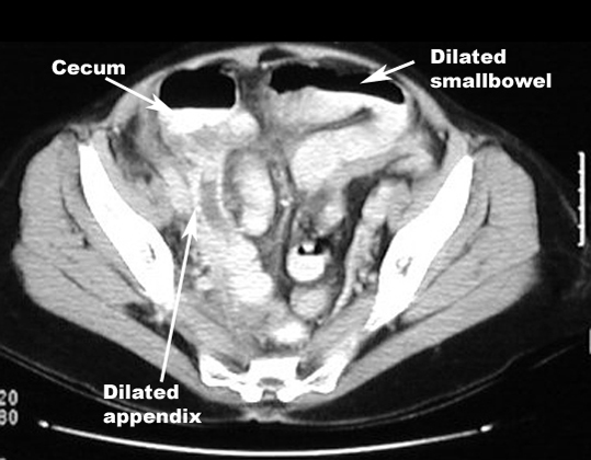 Sentinel Loop Appendicitis