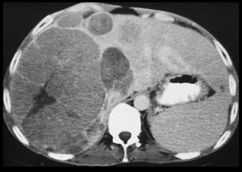 CT scan in a patient with Multicentric hepatoma