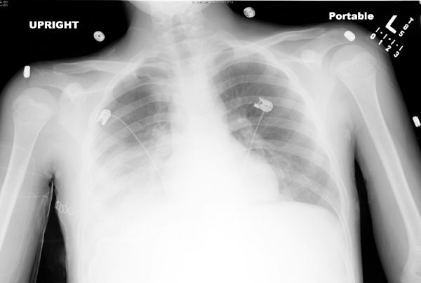 CXR
