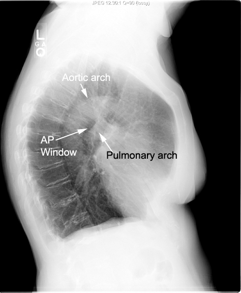 Ascending Aorta