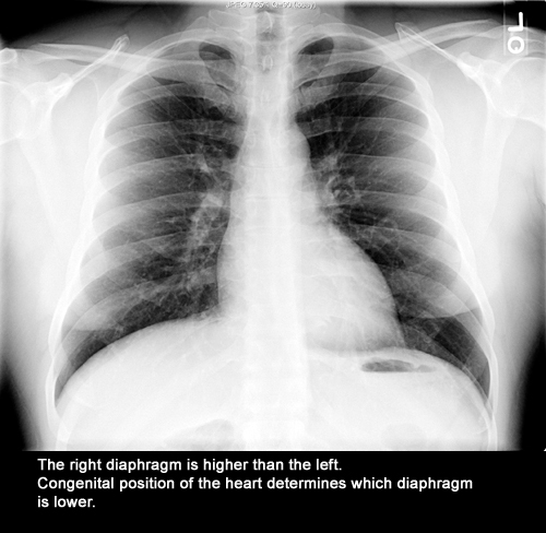 Identify the diaphragm positions. Which diaphragm is higher and why ...