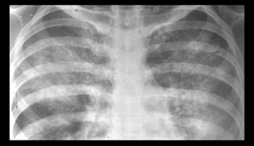 Image of Sarcoidosis - Lung Parenchymal Disease